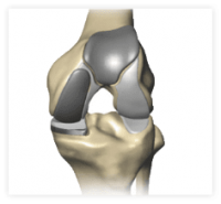 Mako Partial Knee Replacement | SURGICAL HOSPITAL OF OKLAHOMA, LLC.
