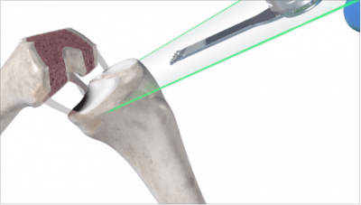 Mako Total Knee Replacement | SURGICAL HOSPITAL OF OKLAHOMA, LLC.